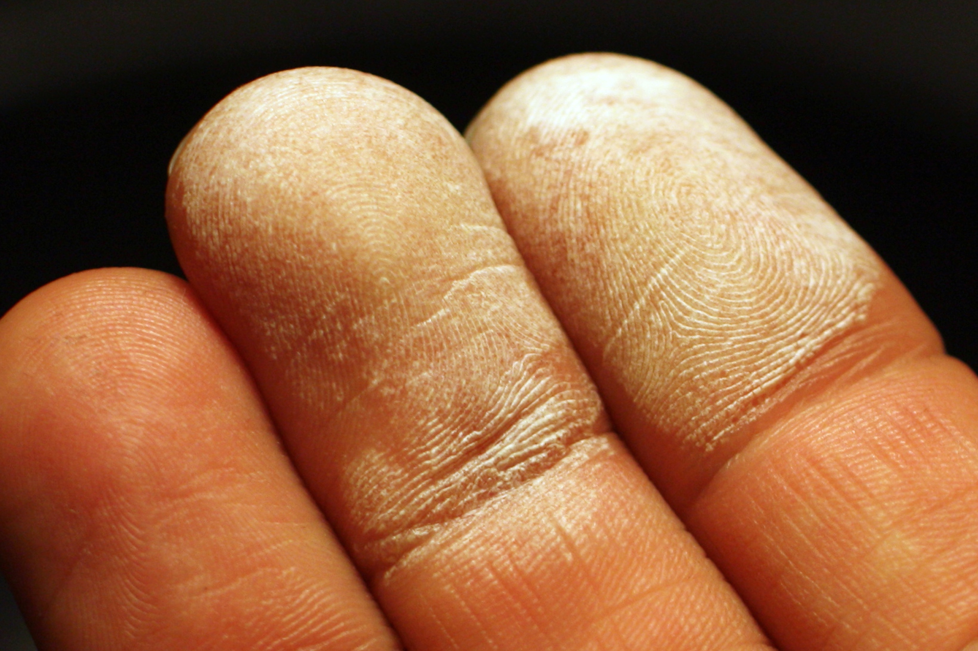 Hydrogen Peroxide Wound